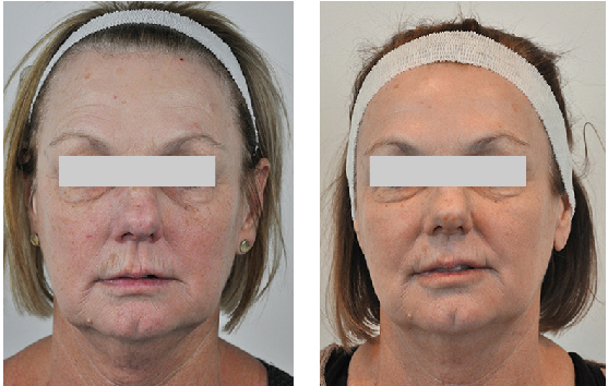 Treatment Of Aging Skin Using The Sharplight Omnimax Multiple Modality
