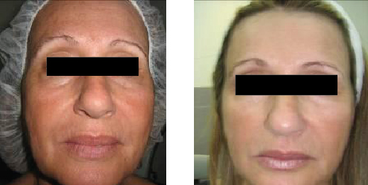 Skin Photo Rejuvenation with the SharpLight DPC Technology ...